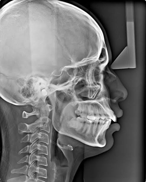 Lateral cephalogram – Moses