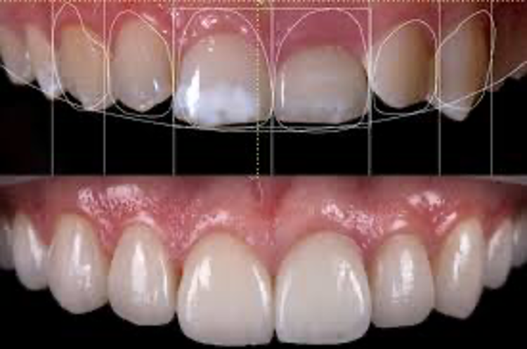 Smile designing – Moses
