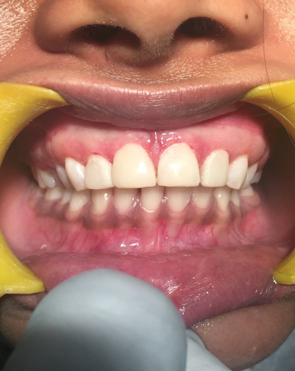 COMMON TREATMENTS WITH LASER – Moses