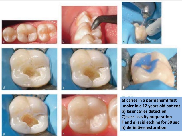 COMMON TREATMENTS WITH LASER – Moses