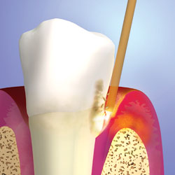 COMMON TREATMENTS WITH LASER – Moses