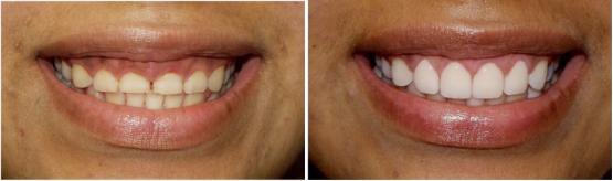 COMMON TREATMENTS WITH LASER – Moses